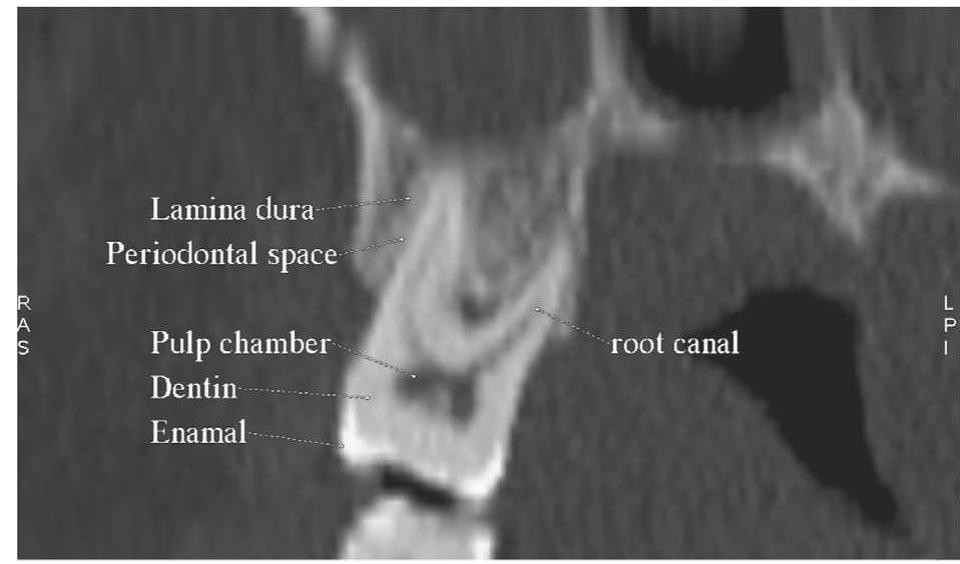 Normal ct anatomy of a maxillary molar tooth. diseased