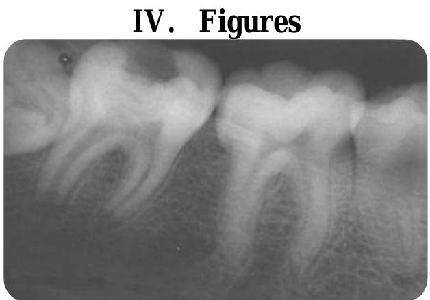1 iopa x-ray showing deep occlusal caries invading the pulp