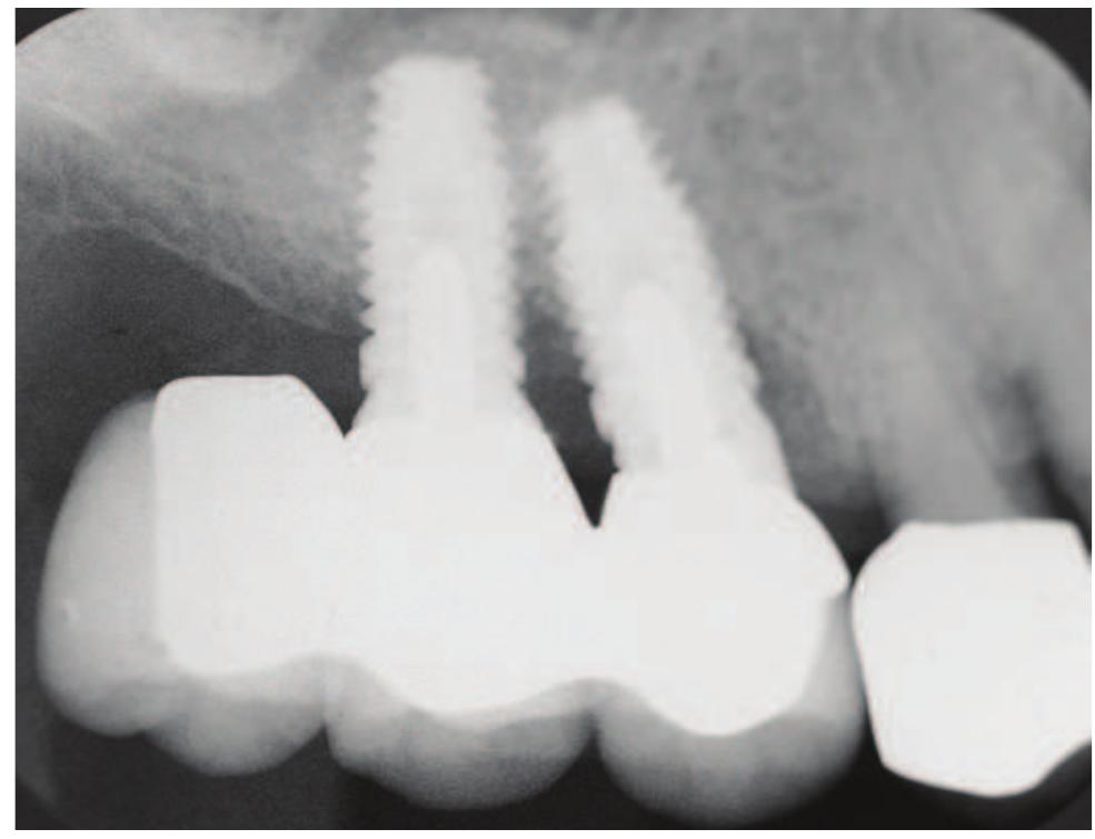 Periapical radiograph of a cantilevered bridge (teeth nos.