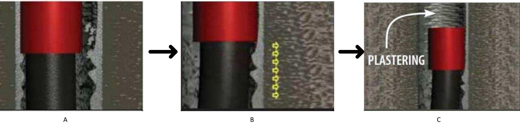 -5: the casing is being forced against the wellbore while