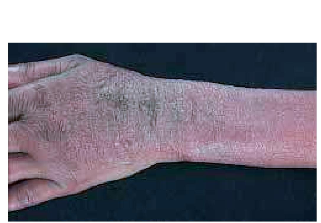 Sheeted eczema over the dorsal aspect of the hand and up to