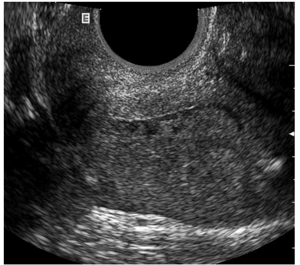 Transvaginal sonographic image of a stage ia endometrial