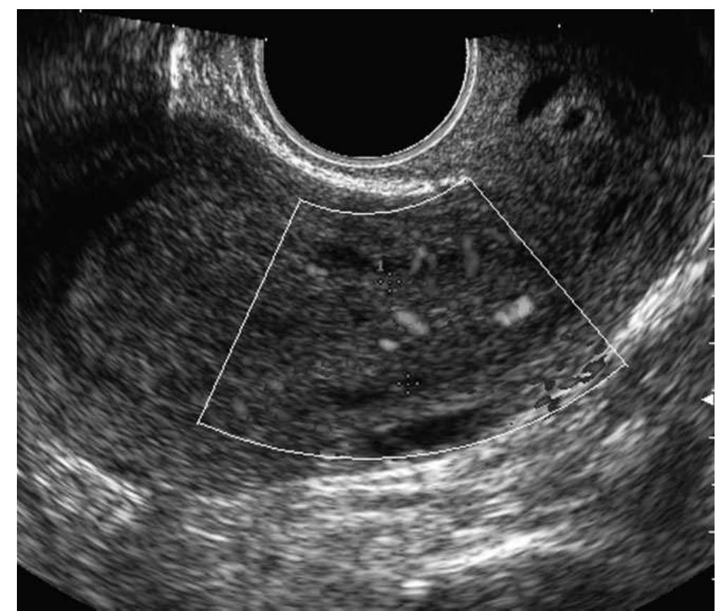 Transvaginal sonographic b-mode image of a patient with