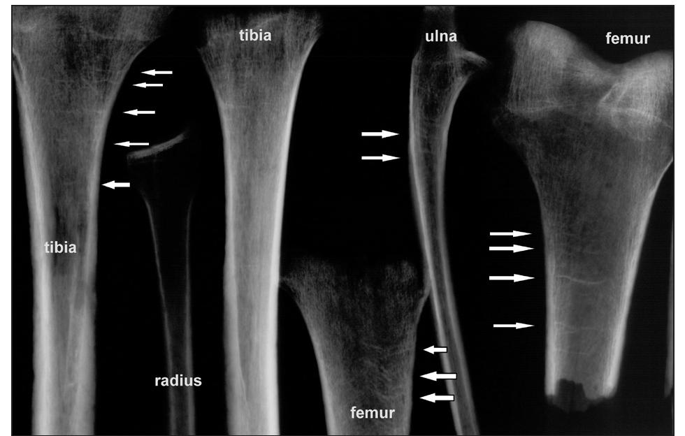T,, g,, 3, 18-20 y. o. harris lines (tibia, femur, radius