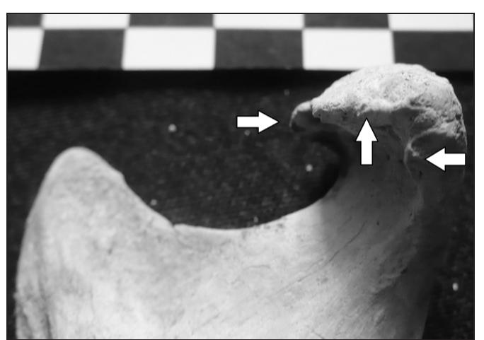 T., g,, 3, 35-40 y. o. osteophytes at the left mandibular