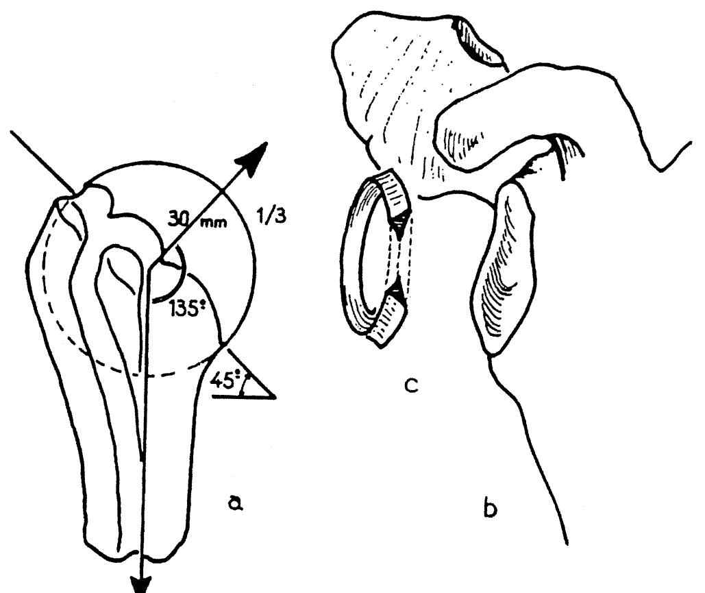 The articular surfaces of the glenohumeral joint are typical