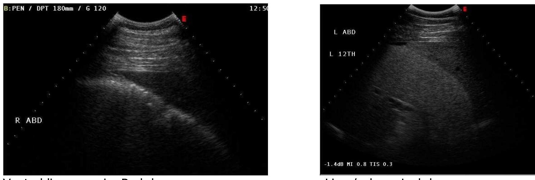 Ventral liver margin, r abdomen spleen: the spleen is