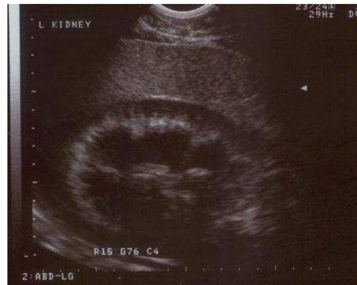 3 months later, chronic renal disease and mineralization l