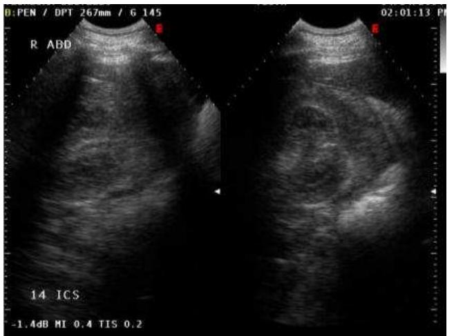 Cecocolic intussusception (same horse)