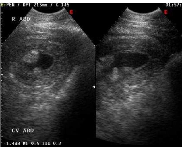 Thick colon and clot, cecocolic intussusception peritoneal
