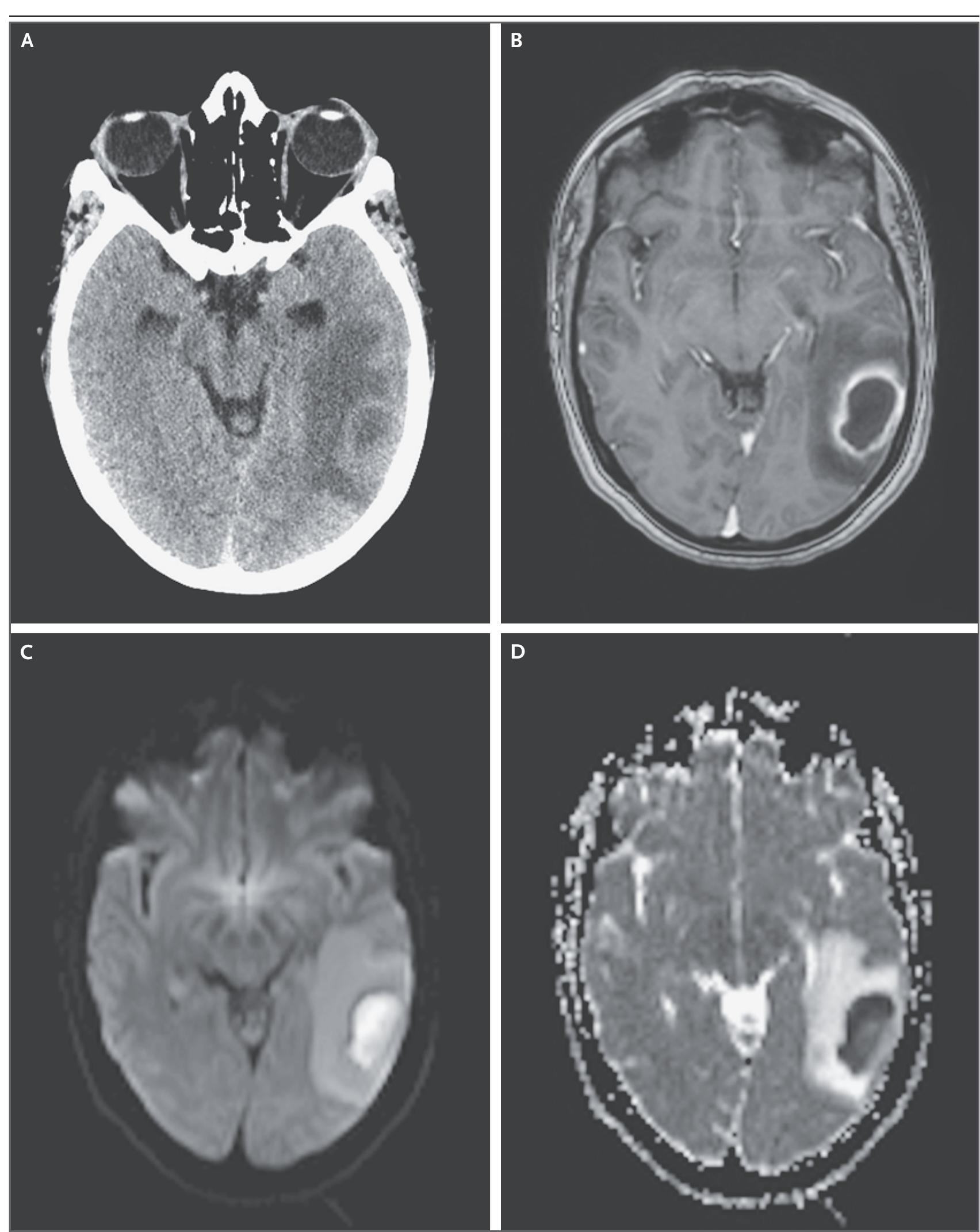 Imaging studies of brain abscess. an axial ct image of the