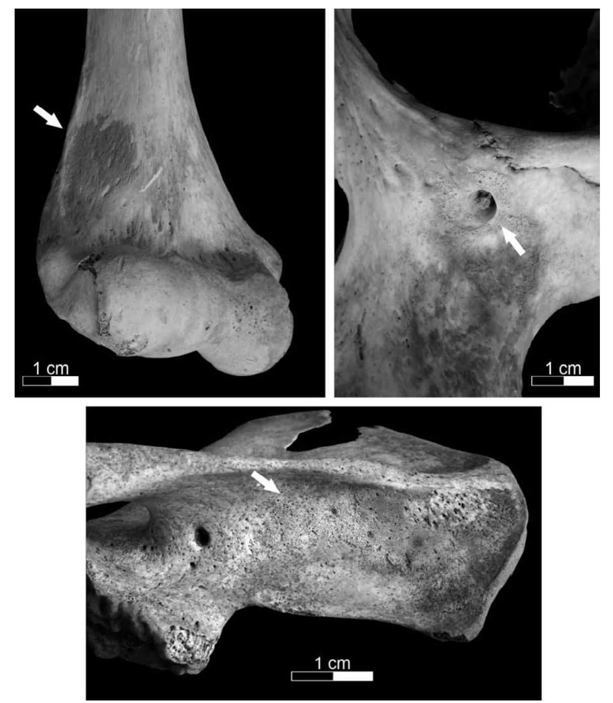 New bone formation on the distal humerus (18-25 year old