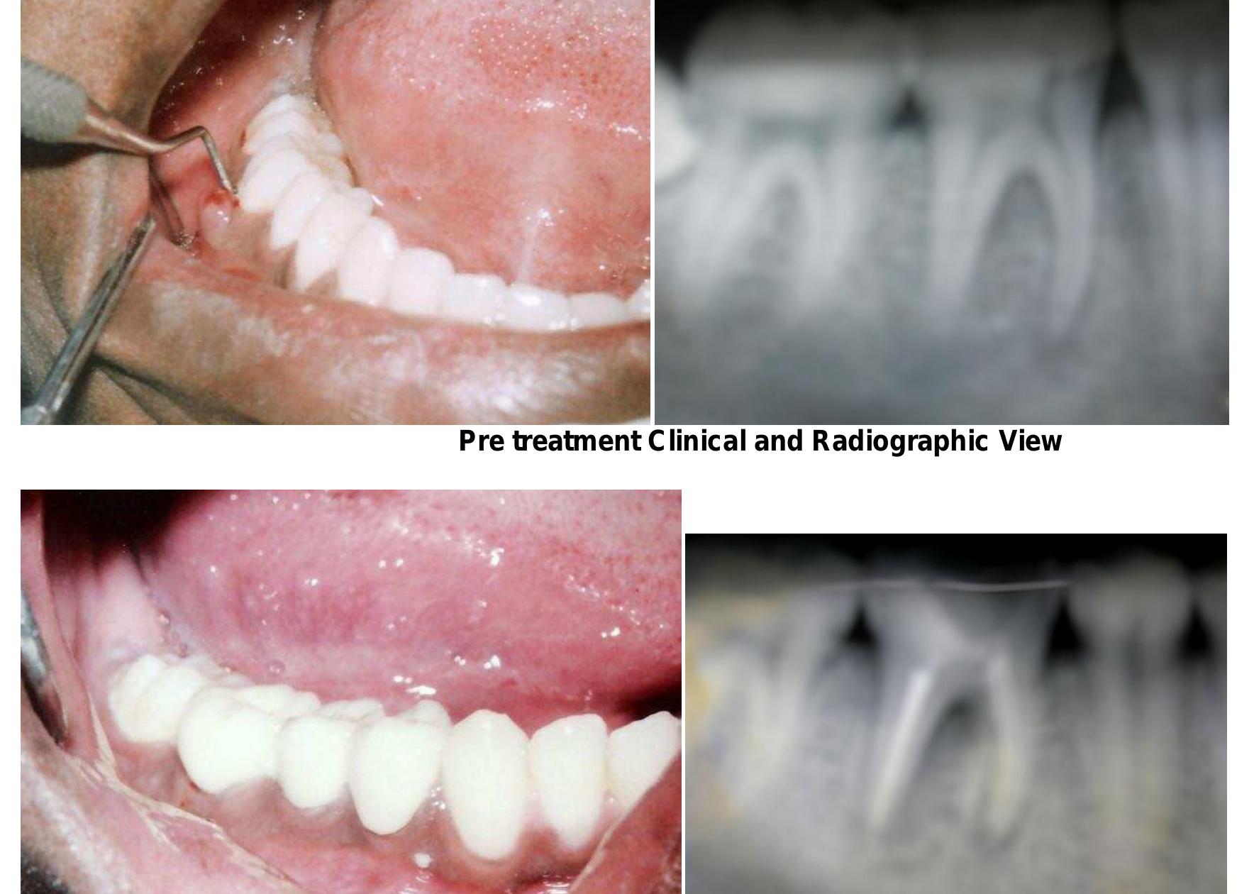 Figure 4 - Endo-Perio Lesions