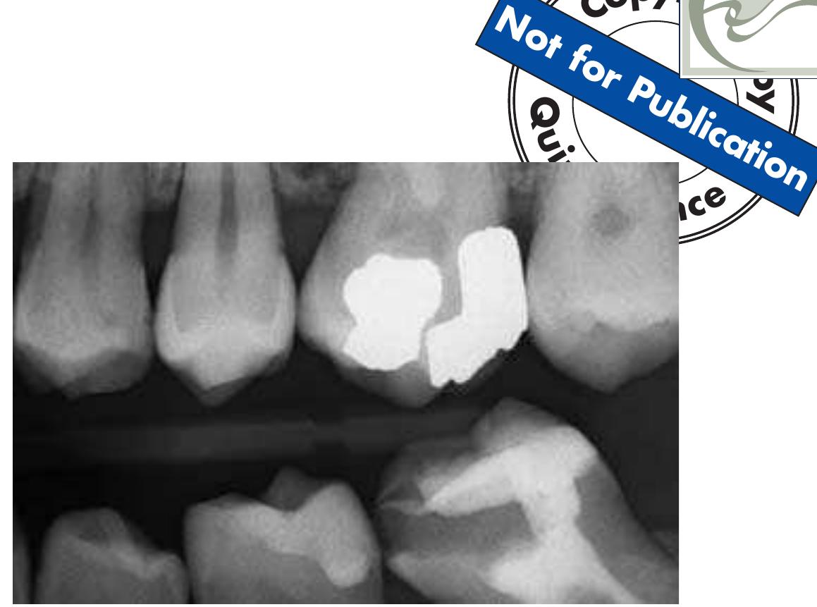 Bitewing radiograph shows the presence of a lesion near the