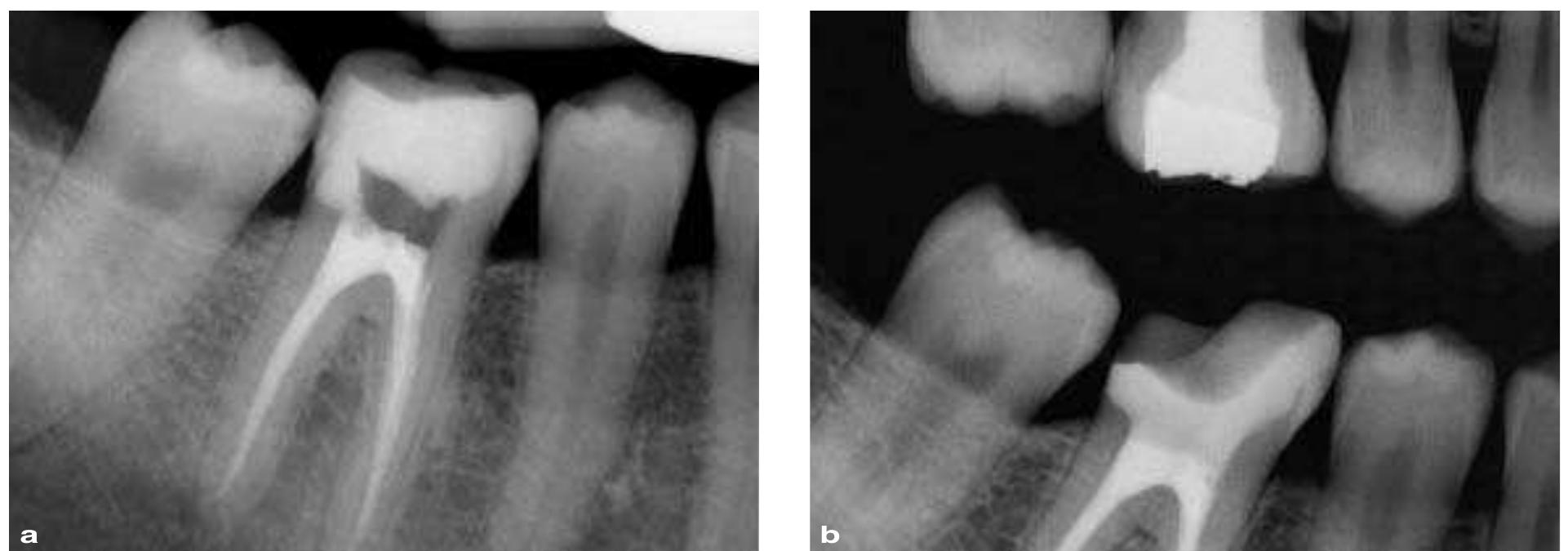 S ta and 1b radiographs taken (a) before and (6) after
