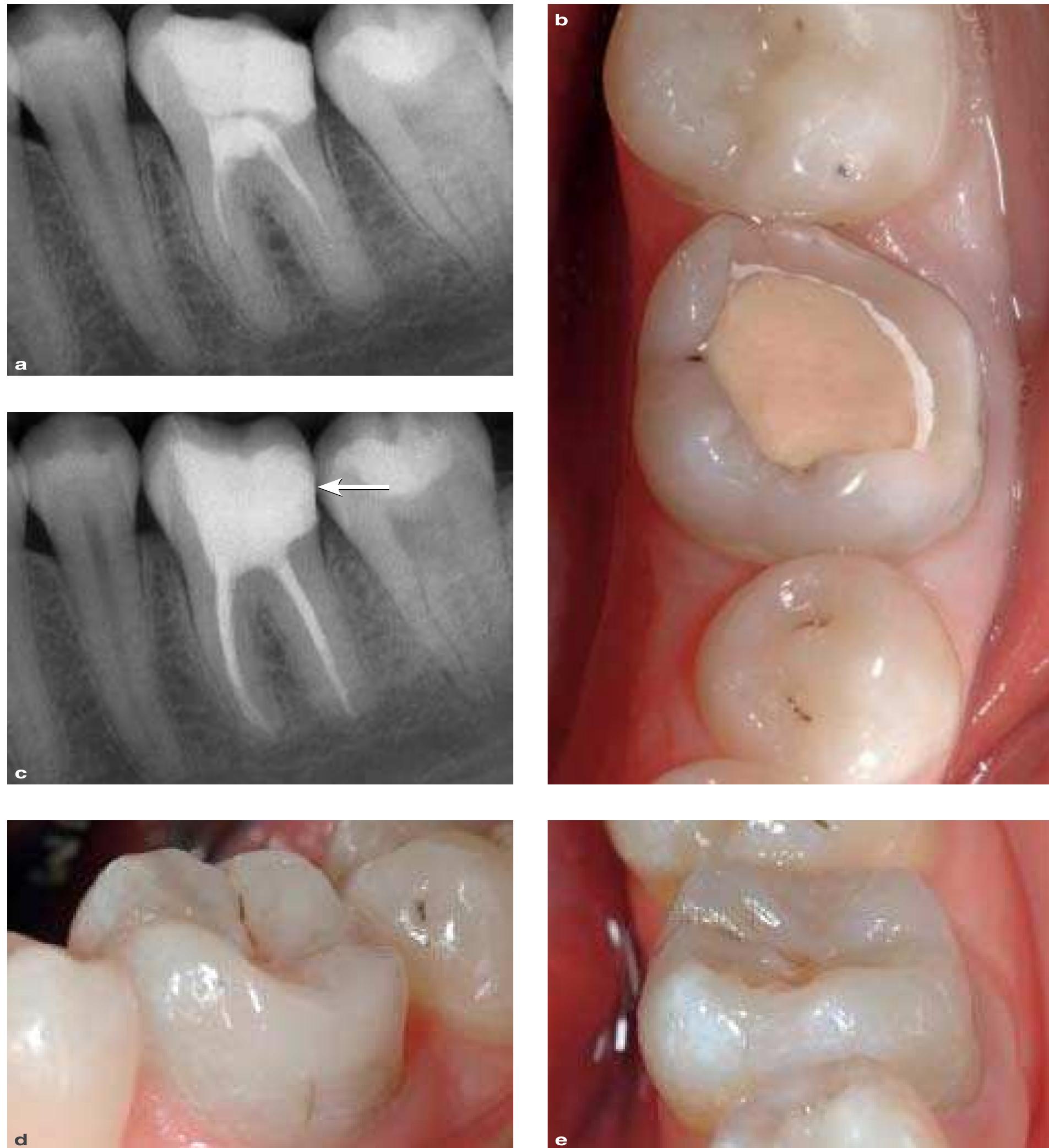(PDF) Deep Margin Elevation_A Paradigm Shift