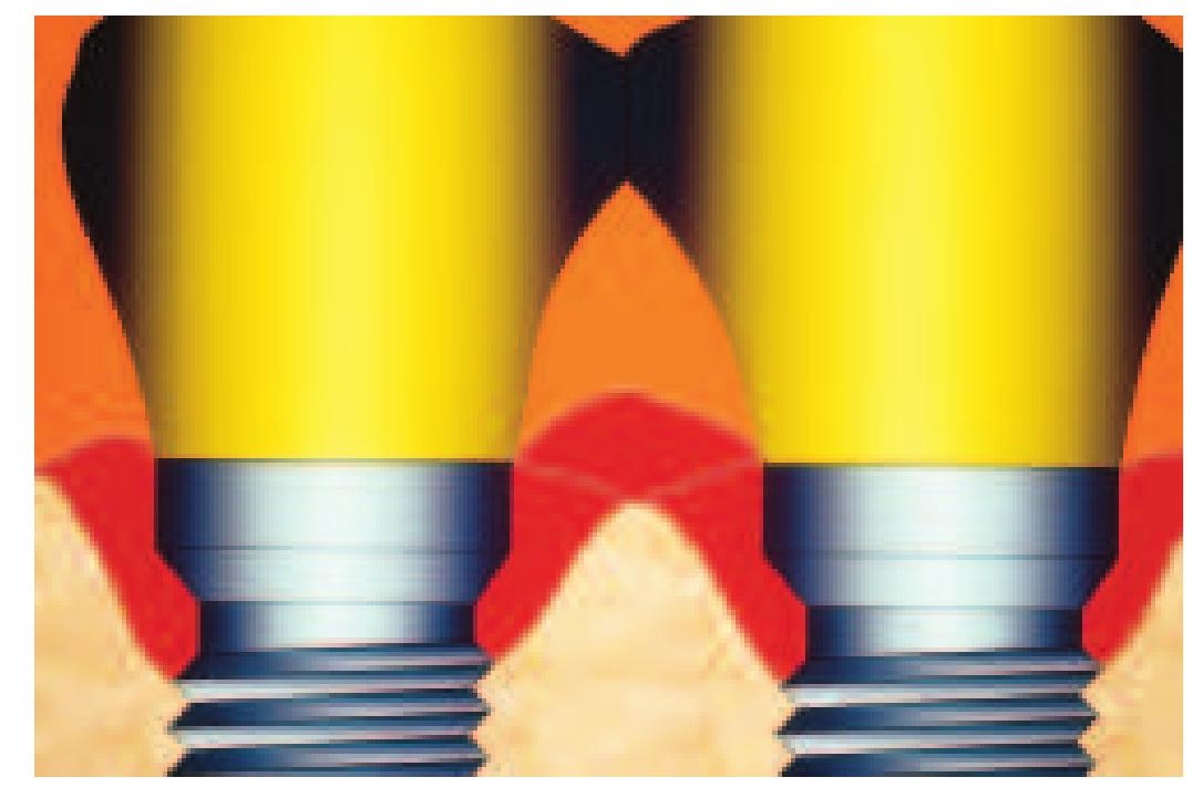 Figure 2 - from Tarnow. The Effect of Inter Implant Distance