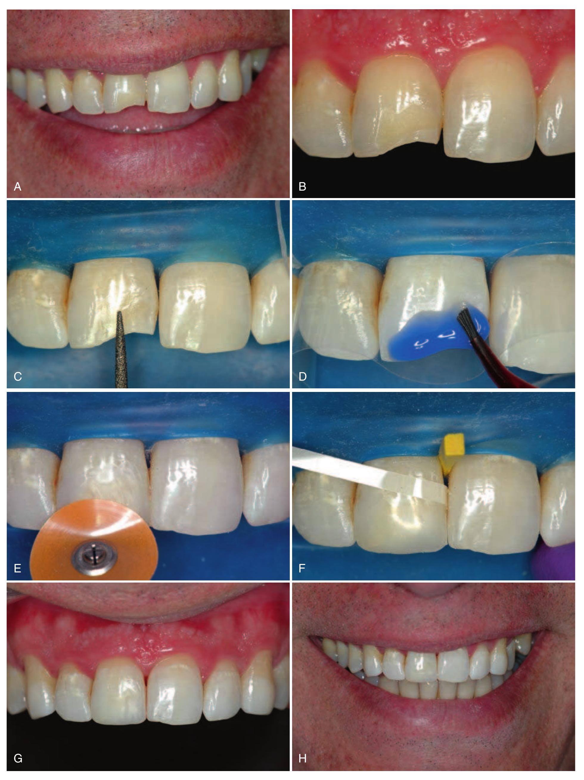(PDF) STURDEVANT'S ART AND SCIENCE OF OPERATIVE DENTISTRY - SOUTH ASIAN ...