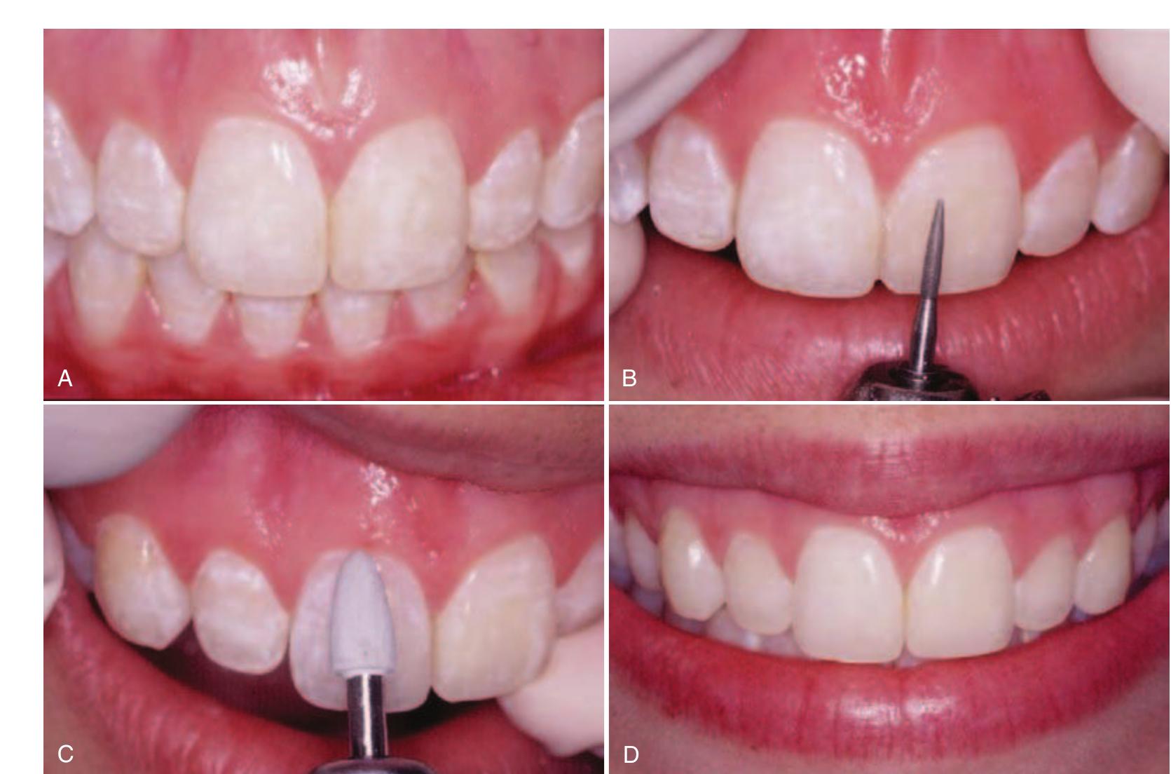 (PDF) STURDEVANT'S ART AND SCIENCE OF OPERATIVE DENTISTRY - SOUTH ASIAN ...