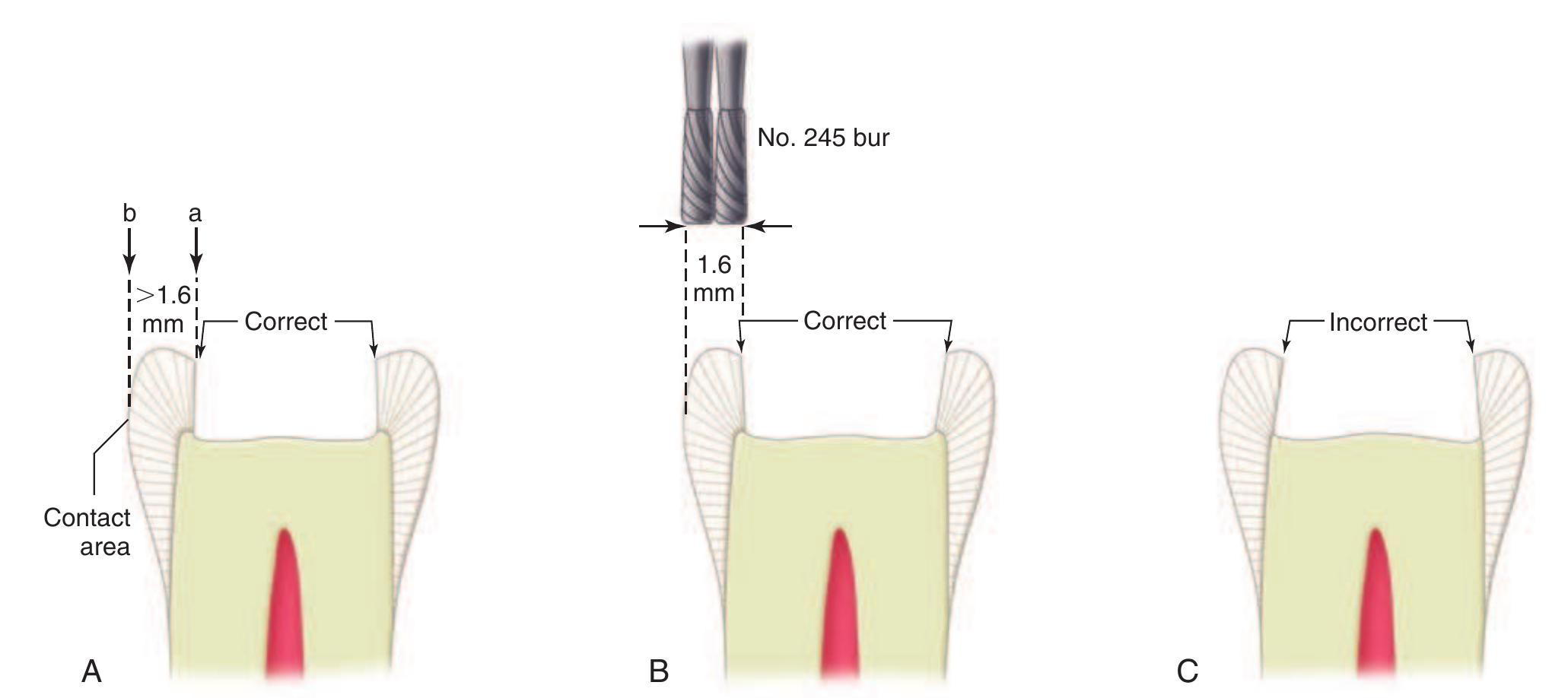 5 the direction of the mesial and distal walls is influenced