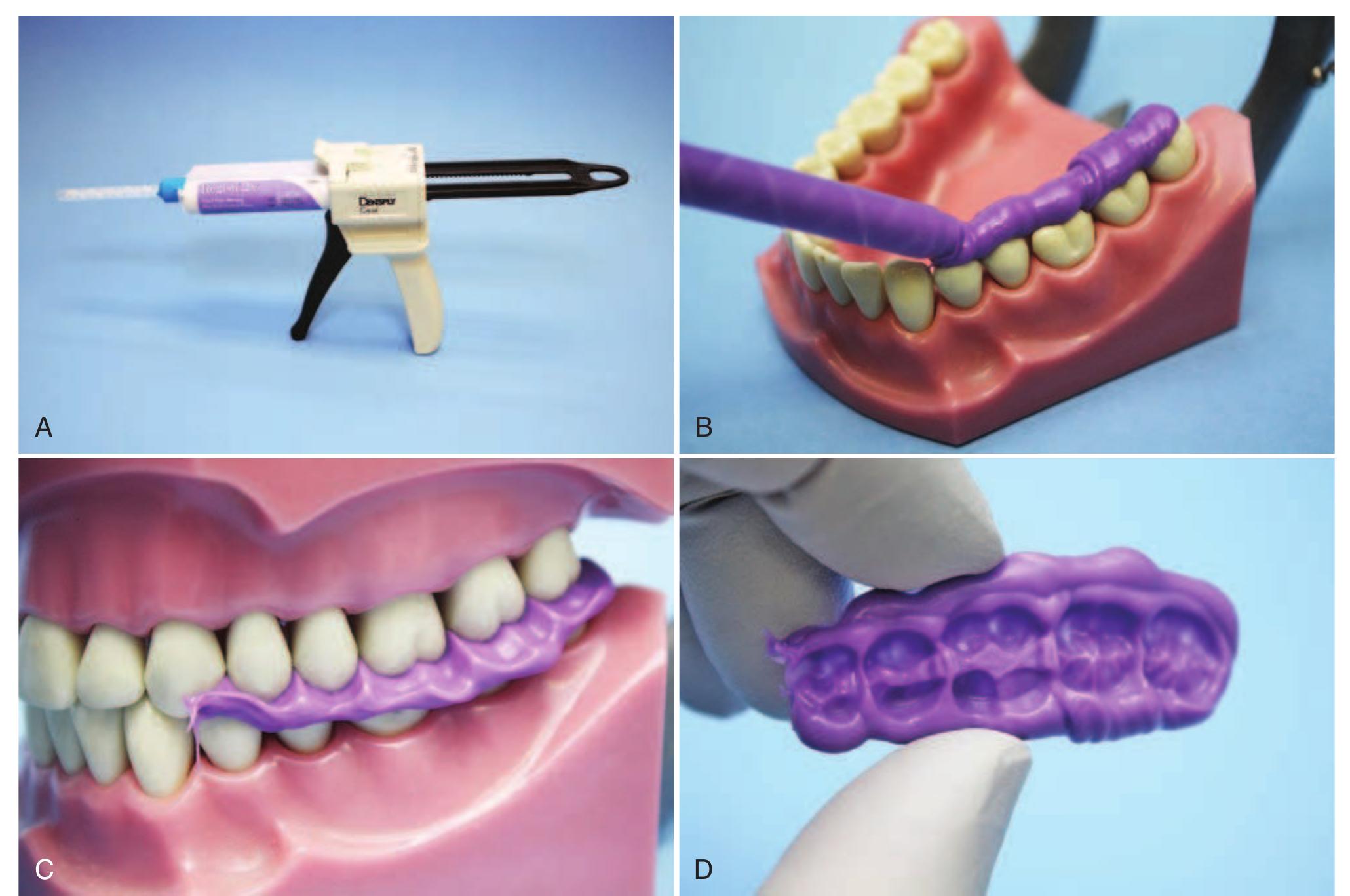18 maximum intercuspation interocclusal record made with