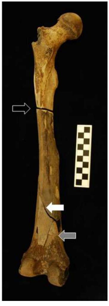 Posterior view of left femur from loc#:79. the white arrows