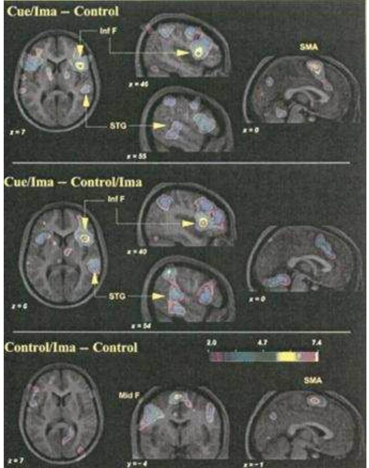 Patterns Of Activations Of The Neural Substrates Underlying