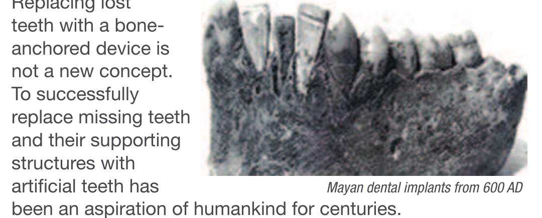 (PDF) A Dentist's Guide to Implantology