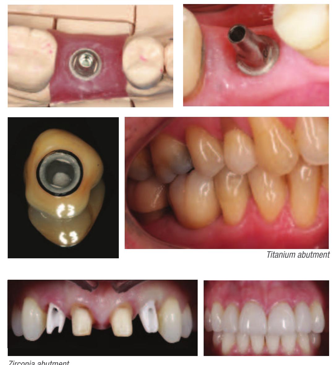 (PDF) A Dentist's Guide to Implantology