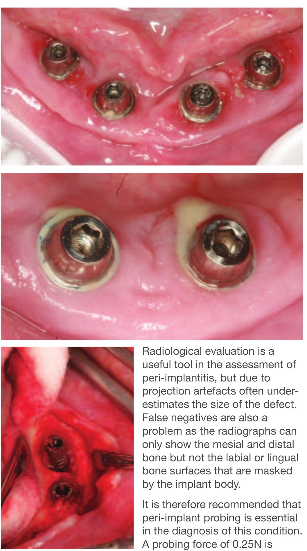 Peri-implantitis is an inflammatory process affecting the
