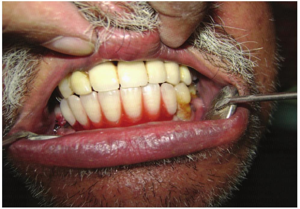 Figure 4 - Cast removable partial denture improving