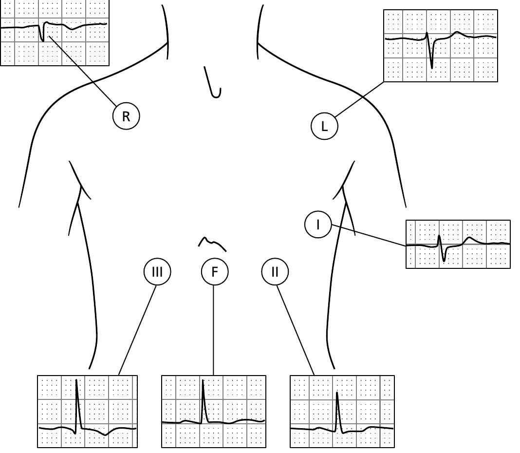 Increased ventricular activation time (vat) in the right