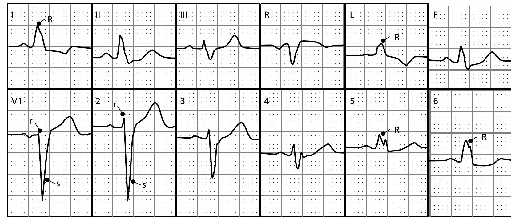10 left bundle branch block. figure 4.9 ventricular