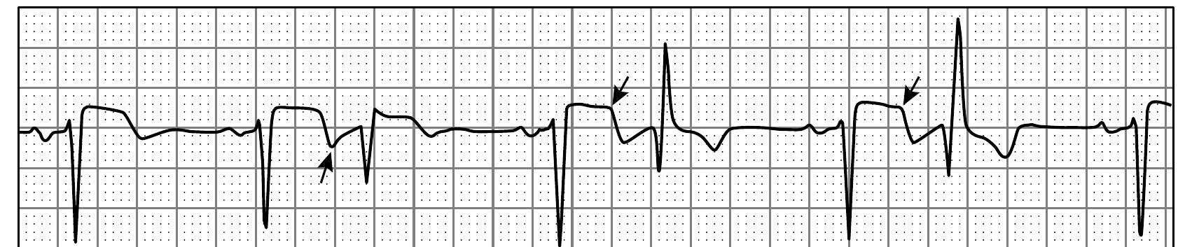 15 ashman’s phenomenon: atrial extrasystoles (arrows) ending