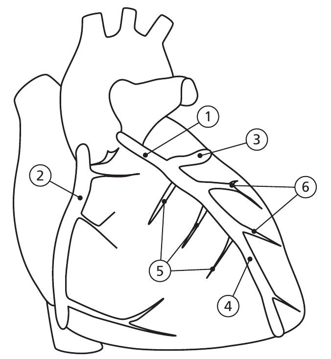 1 coronary artery anatomy. 1: left main, 2: right coronary,