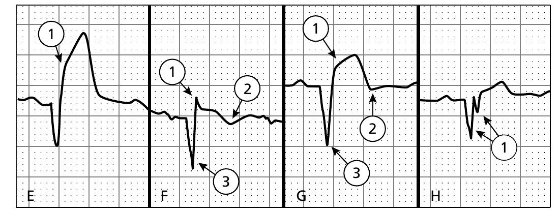 9 the hyperacute phase of myocardial infarction. tall,