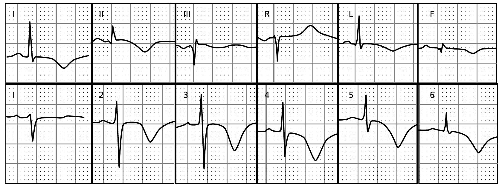 17 the ecg of a patient with subarachnoid hemorrhage: