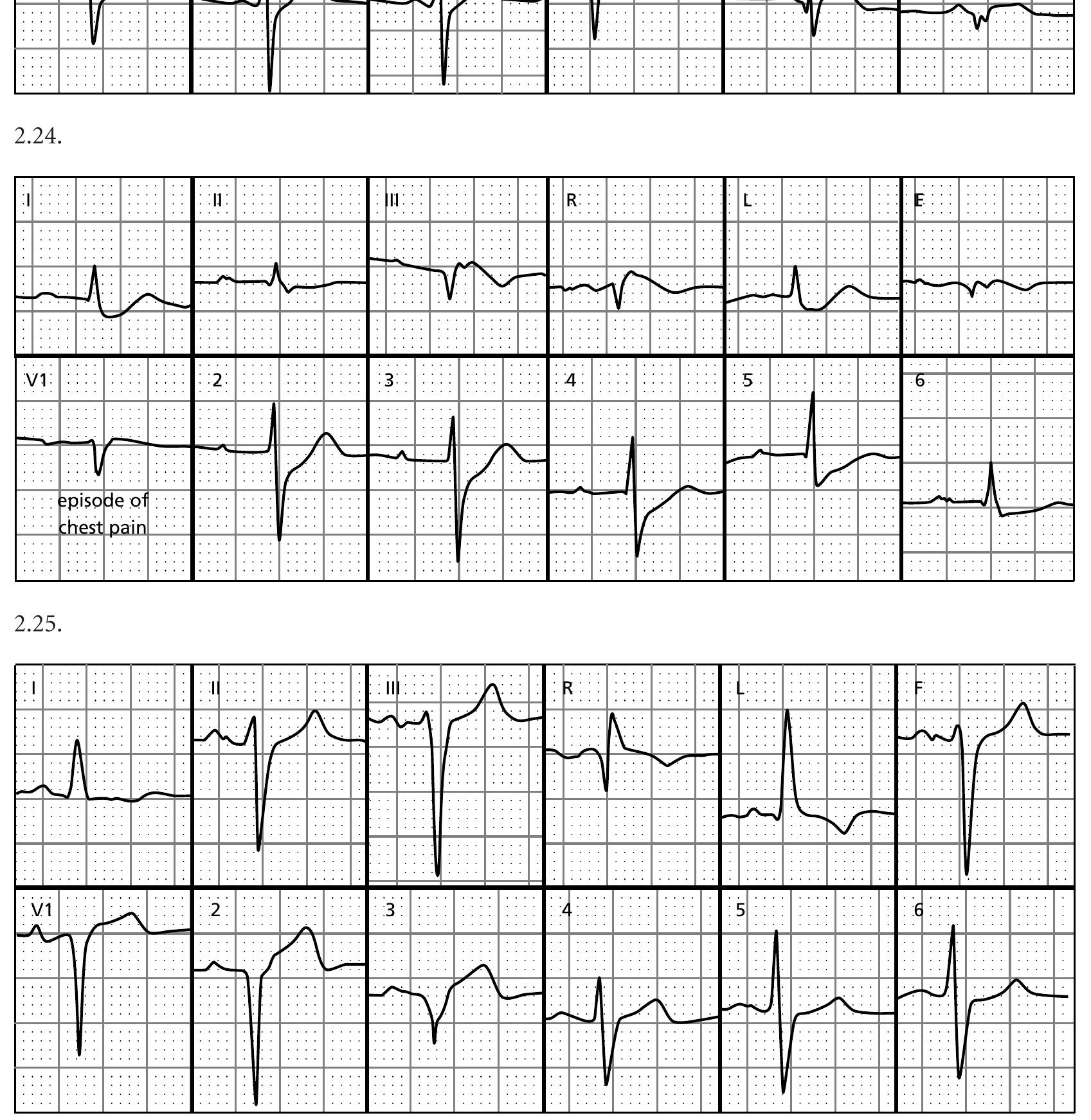 Figure 78 - ECG interpretation