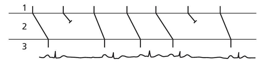 Figure 90 - from ECG interpretation