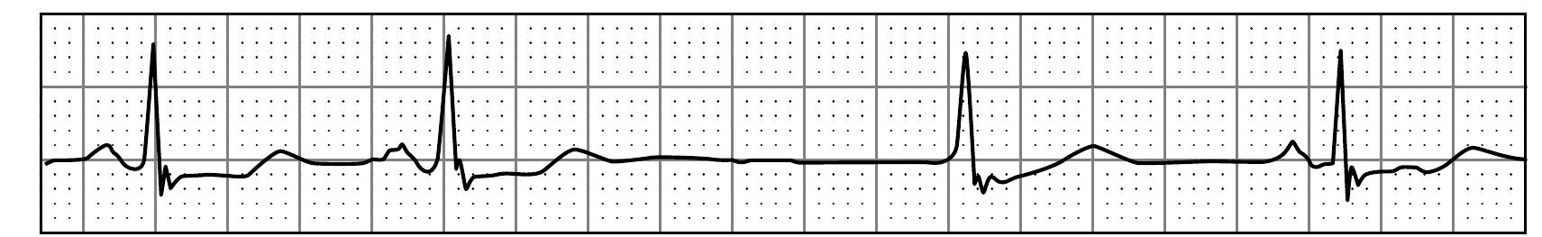 Figure 92 - from ECG interpretation