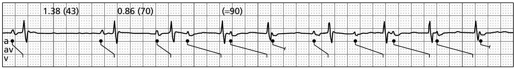7 paroxysmal atrioventricular block triggered by an increase