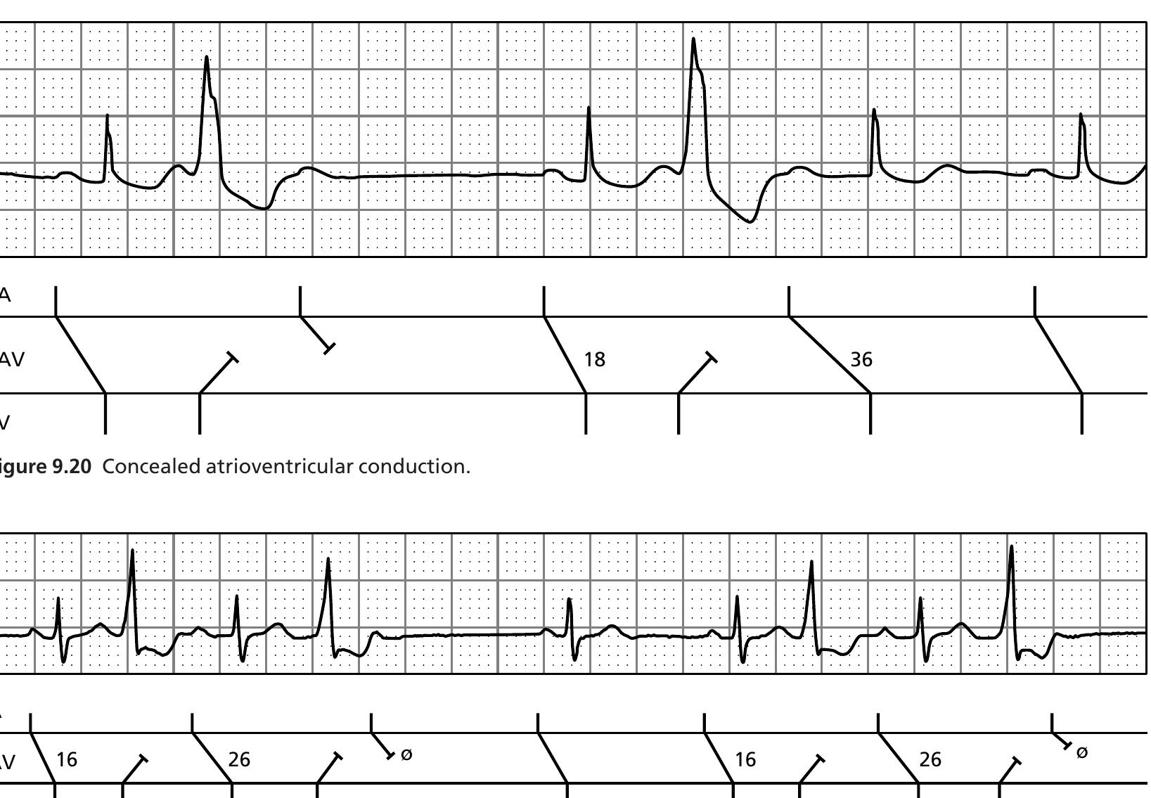 21 concealed atrioventricular conduction. laddergram, which