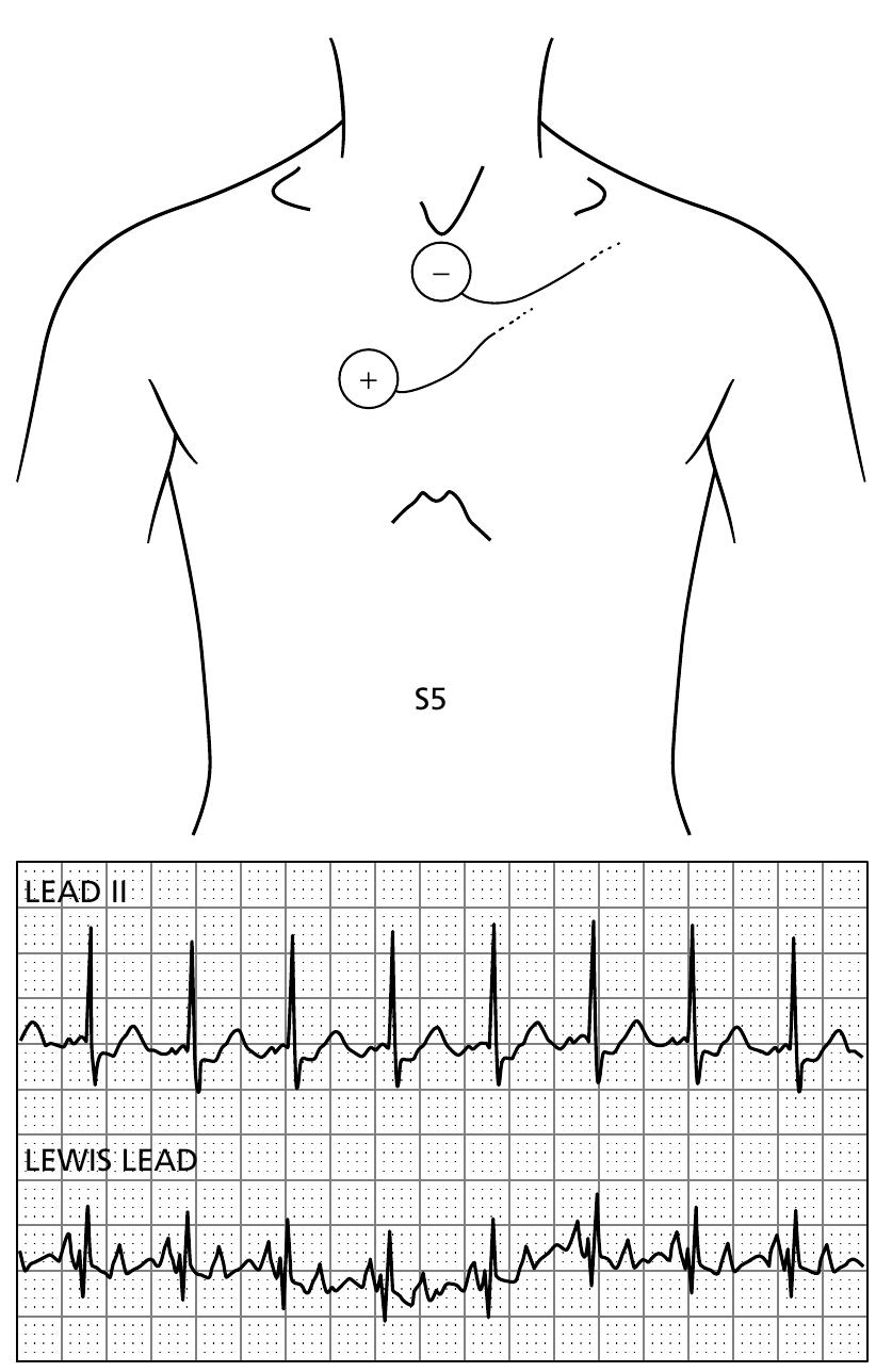 13 the lewis lead used to clarify atrial activity. the