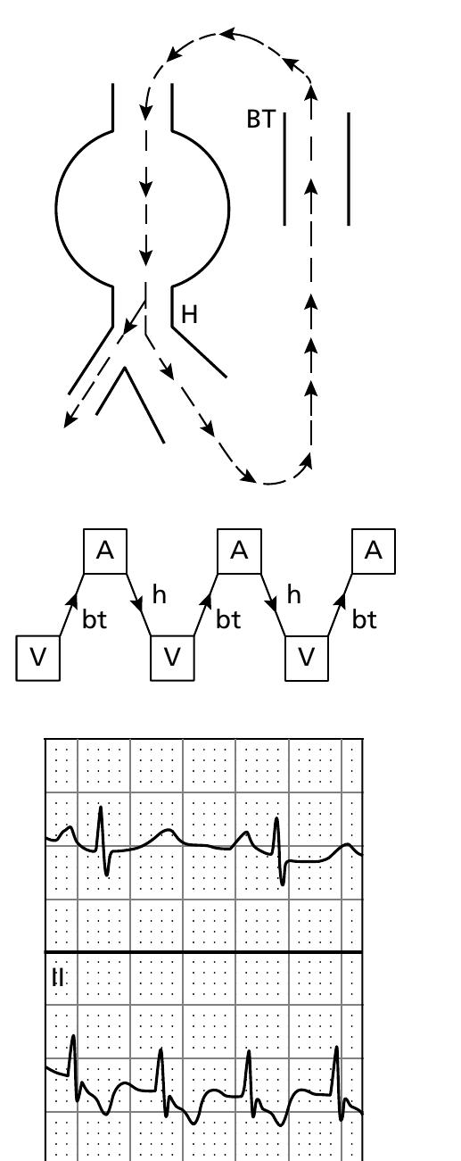 4 atrioventricular re-entrant tachycardia (avrt): negatively