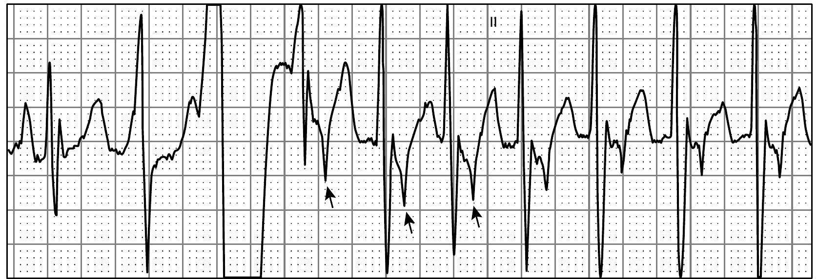 7 a pair of premature ventricular complexes initiate avrt.
