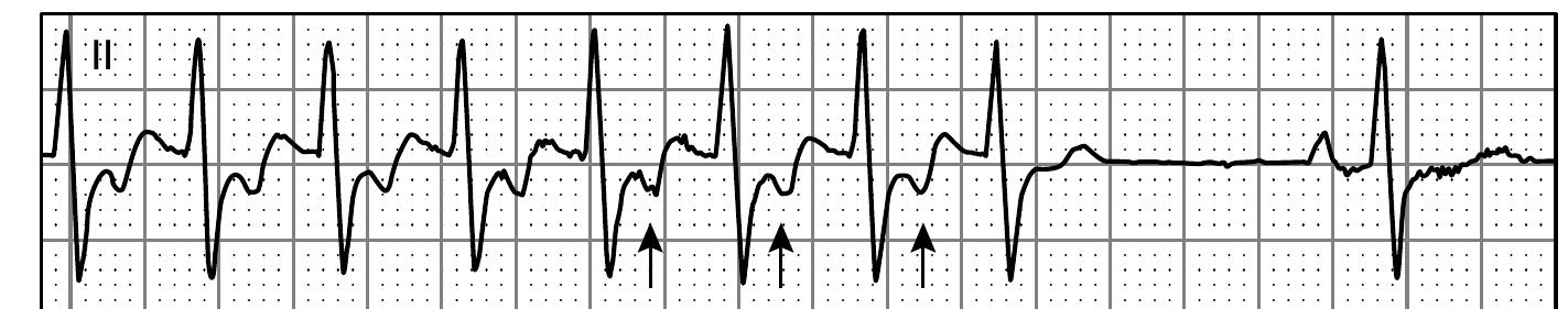 13 atrioventricular re-entrant tachycardia (avrt).