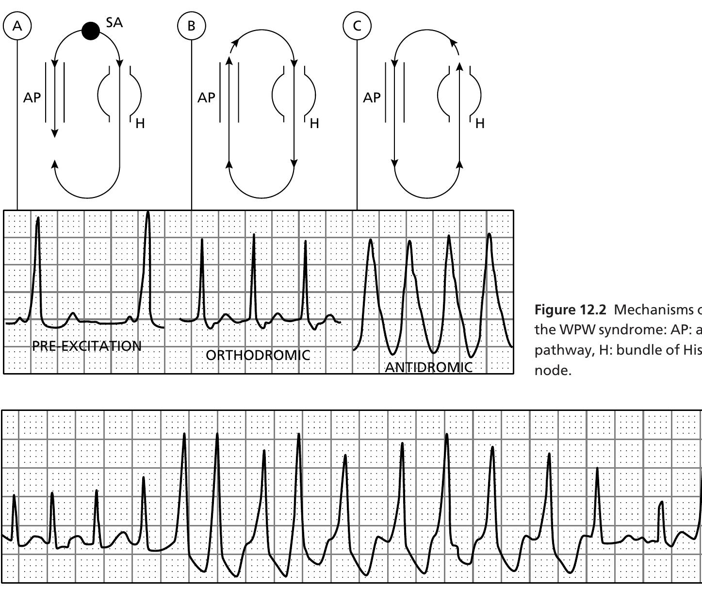 3 atrial fibrillation in a patient with wpw syndrome: the