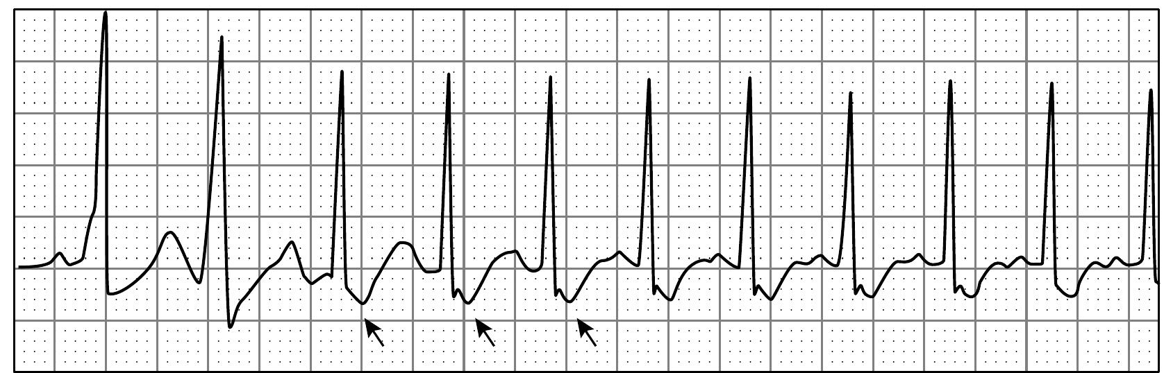 4 orthodromic tachycardia: note the retrograde p waves