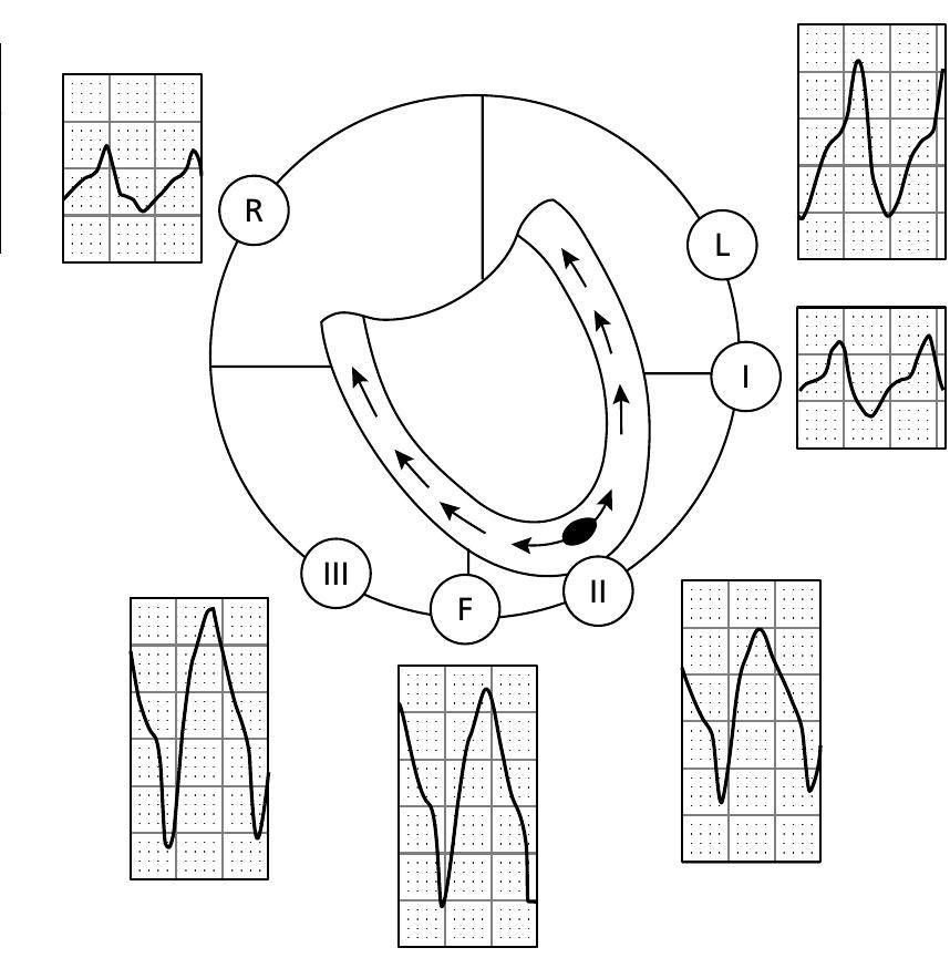 7 ventricular tachycardia with left superior axis: the