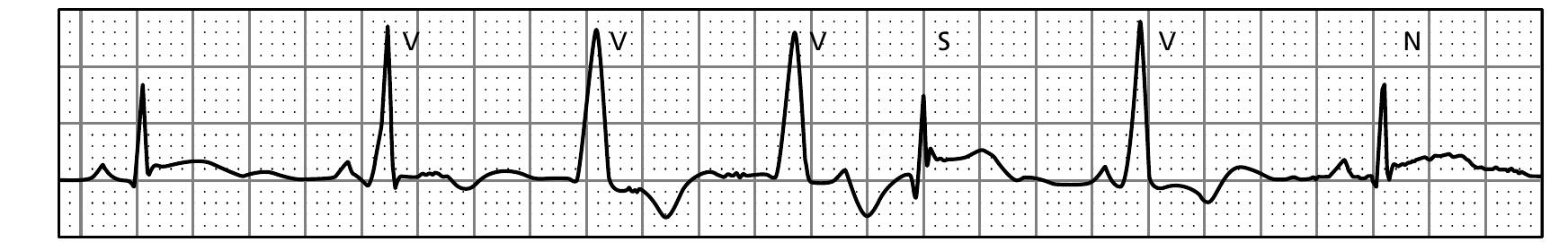Figure 265 - from ECG interpretation